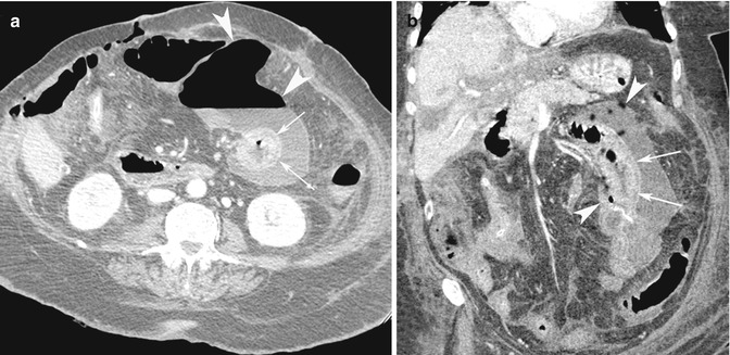 Imaging of Gastrointestinal Tract Perforation in the Oncologic Patients ...