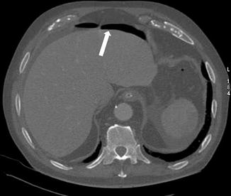 Colorectal Perforation: Assessment with MDCT | Radiology Key