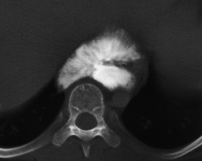 Approach to Bone Lesions | Radiology Key