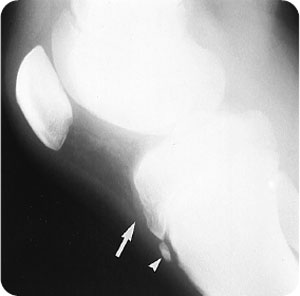 Osgood–Schlatter Disease | Radiology Key