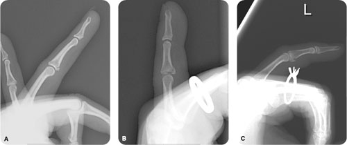 volar plate fractures | Radiology Key