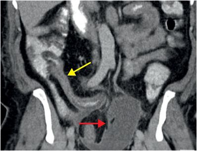 11 26-year-old man presenting with diffuse abdominal pain and diarrhea ...