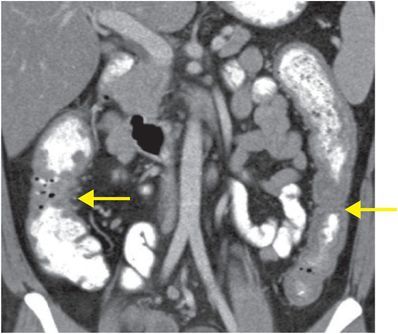 13 68-year-old man with left lower quadrant pain | Radiology Key