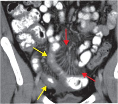 14 17-year-old boy with right lower quadrant and suprapubic pain ...
