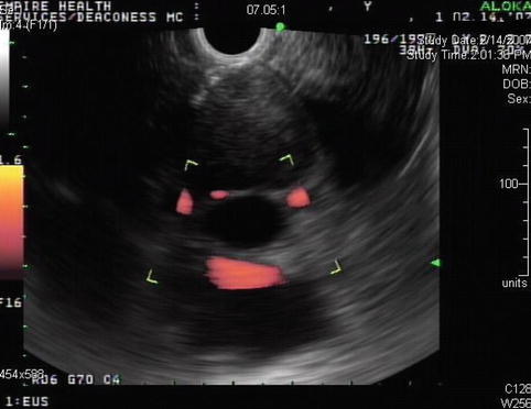 Duodenum | Radiology Key
