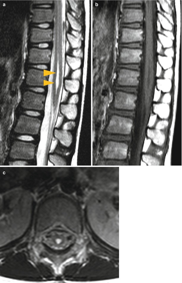Nontumoural Spinal Cord Lesions Radiology Key