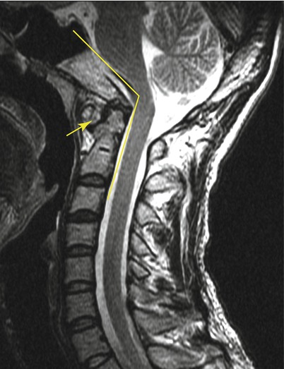 Inflammatory Arthritides | Radiology Key