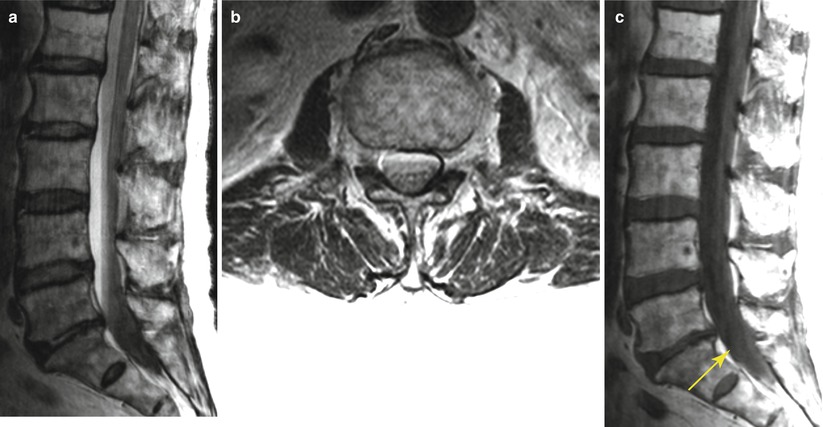 Cervical Trauma | Radiology Key