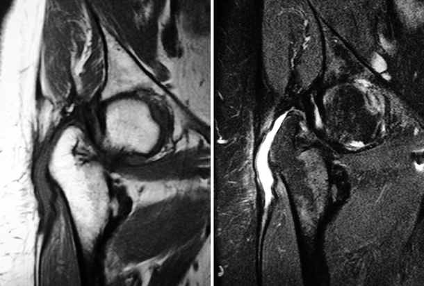 Juvenile Idiopathic Arthritis | Radiology Key