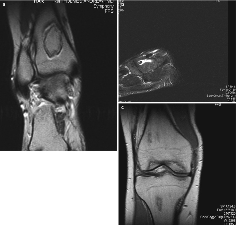 Multifocal Osteonecrosis | Radiology Key