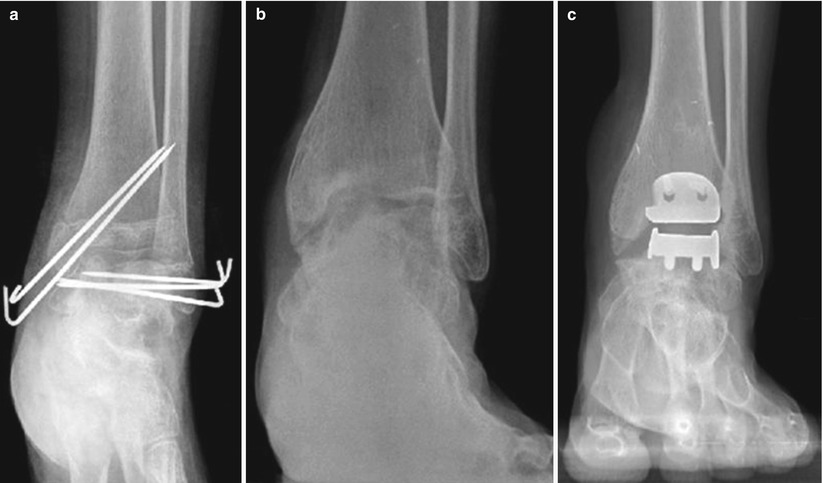 Osteonecrosis of the Talus | Radiology Key
