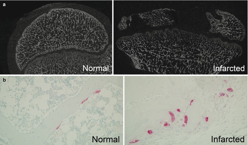 Legg-Calvé-Perthes Disease: Pathology, Pathophysiology, and ...
