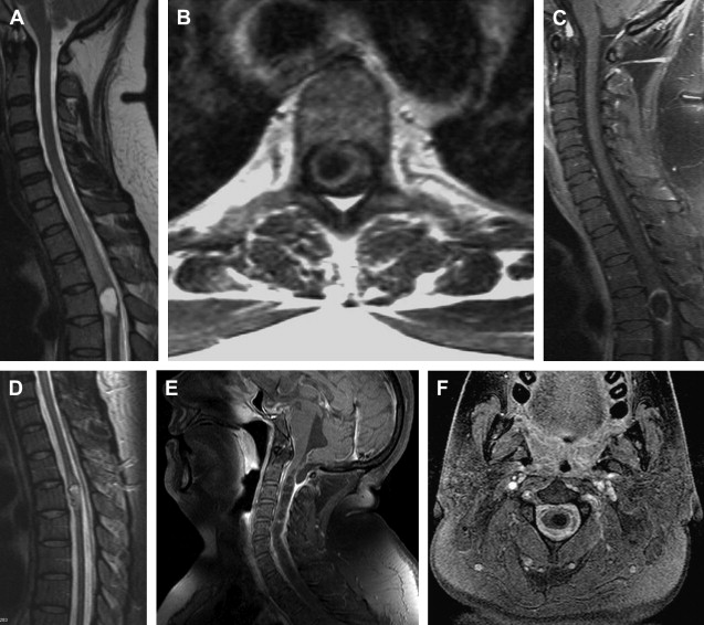 Parasitic Diseases of the Central Nervous System | Radiology Key