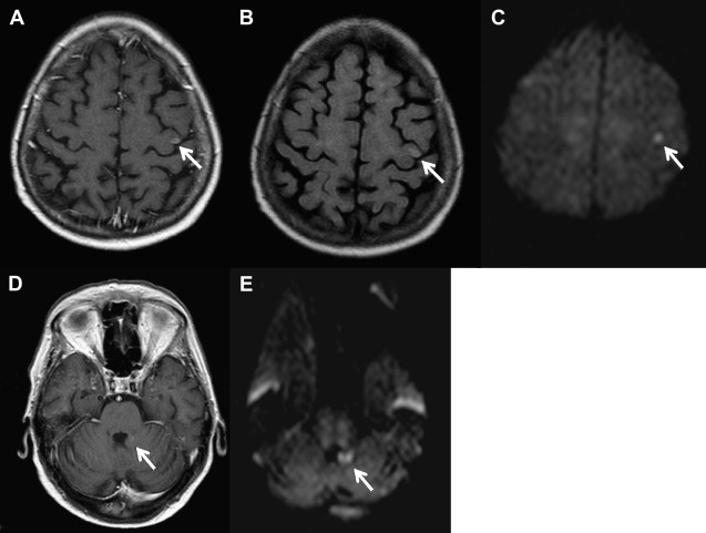 Diffusion MR Imaging: An Important Tool in the Assessment of Brain ...