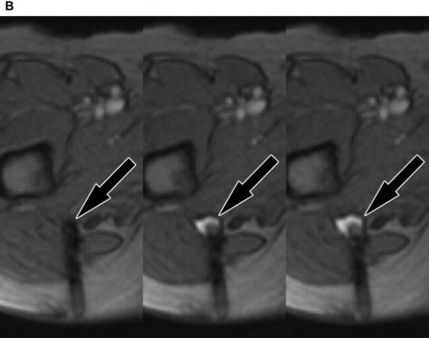 Radiofrequency Neurolysis | Radiology Key