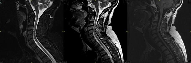 Imaging of the Spine at 3 Tesla | Radiology Key