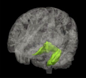 Frontotemporal Lobar Degeneration: New Understanding Brings New ...