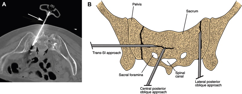 Sacral Fractures and Sacroplasty | Radiology Key