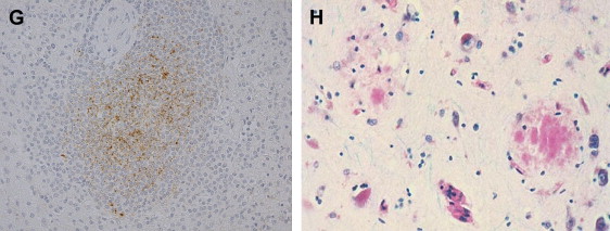 Prion Protein Disease and Neuropathology of Prion Disease | Radiology Key
