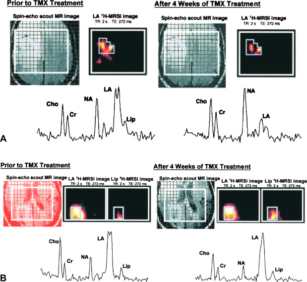 Imaging of Brain Tumors: MR Spectroscopy and Metabolic Imaging ...