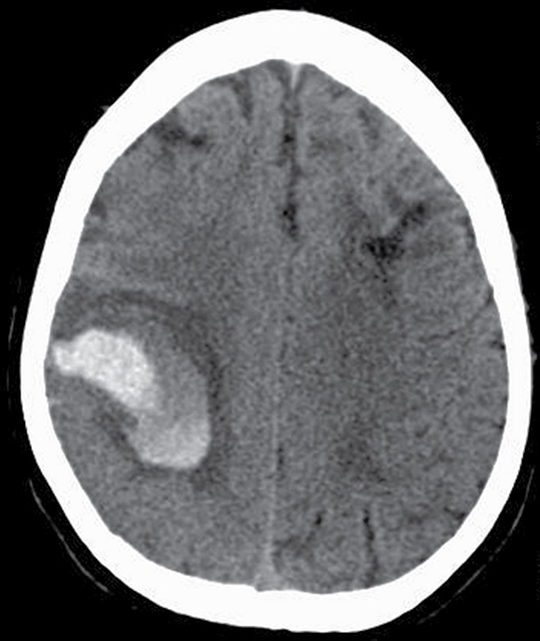 Vascular Diseases of the Brain | Radiology Key