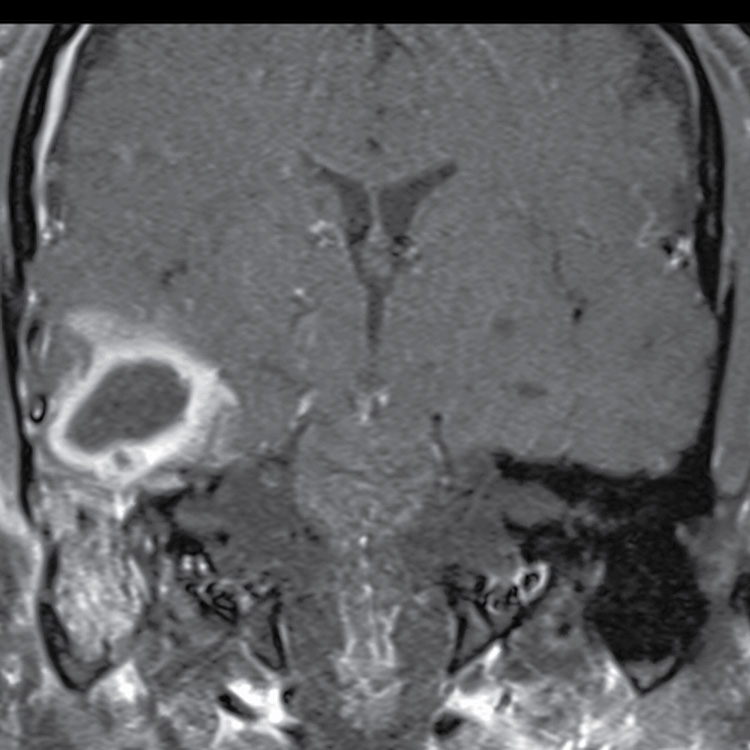 Infectious and Inflammatory Diseases of the Brain | Radiology Key