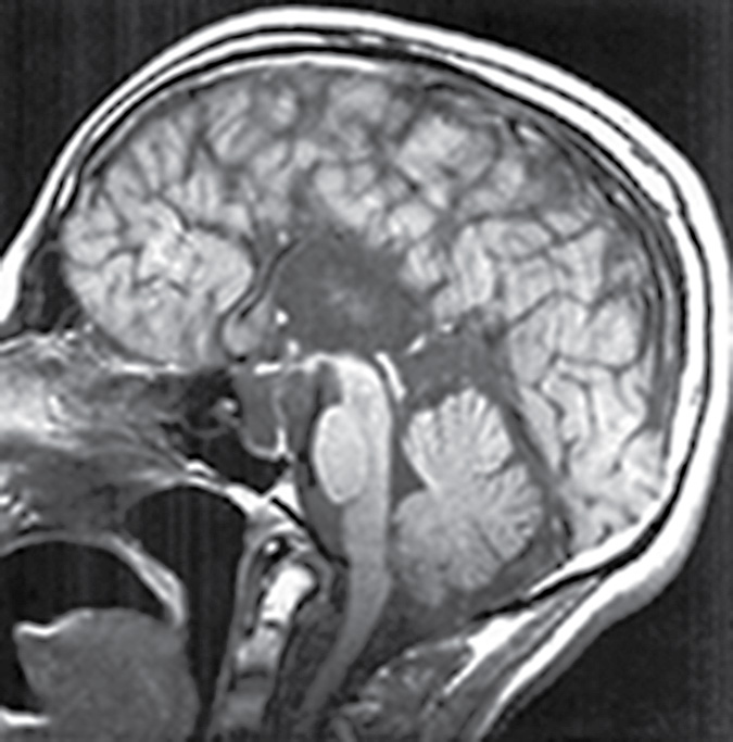 Congenital Disorders of the Brain | Radiology Key