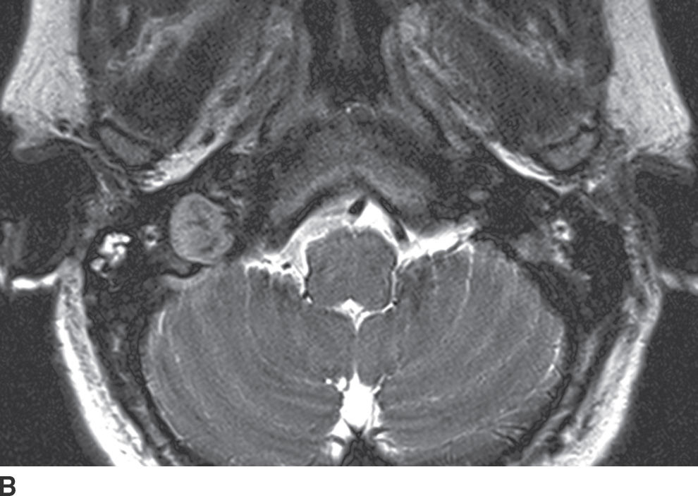 Temporal Bone Imaging | Radiology Key