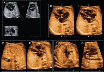 Fetal Echocardiography: Basic and Advanced Applications | Radiology Key