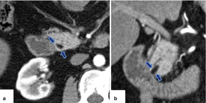 Embryology of the Pancreas and Normal Variants | Radiology Key