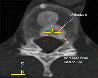 Therapeutic Radiopharmaceuticals for Bone Pain Palliation | Radiology Key