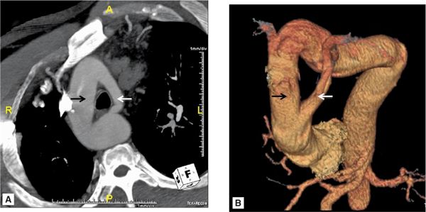 The Aorta | Radiology Key