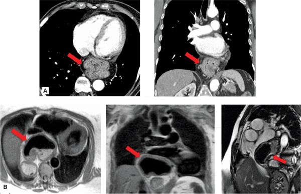 Cardiac Masses | Radiology Key