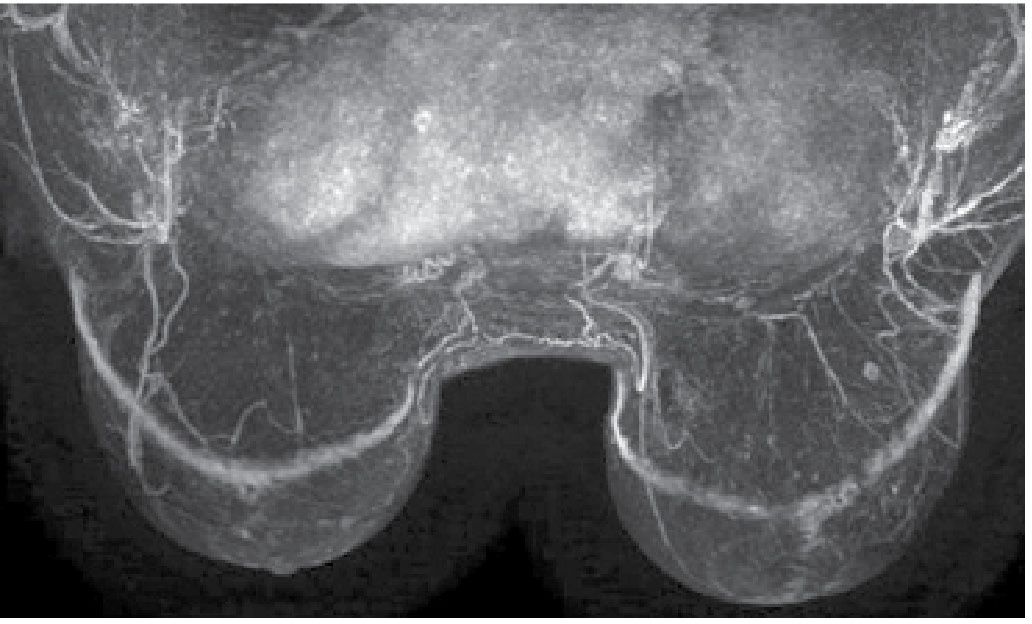 Evaluation and Imaging Features of Malignant Breast Masses | Radiology Key