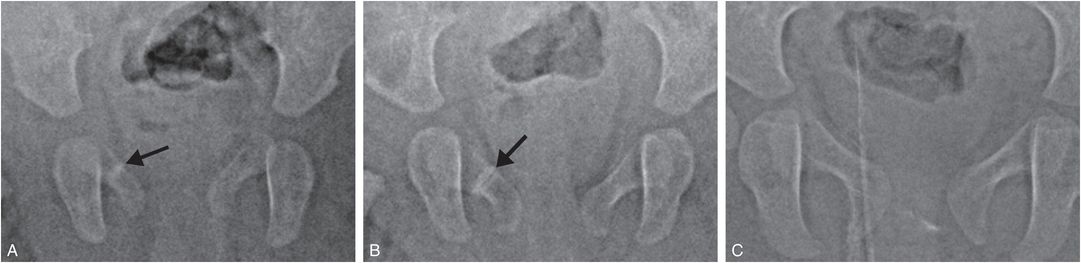 Differential diagnosis VI: normal variants | Radiology Key