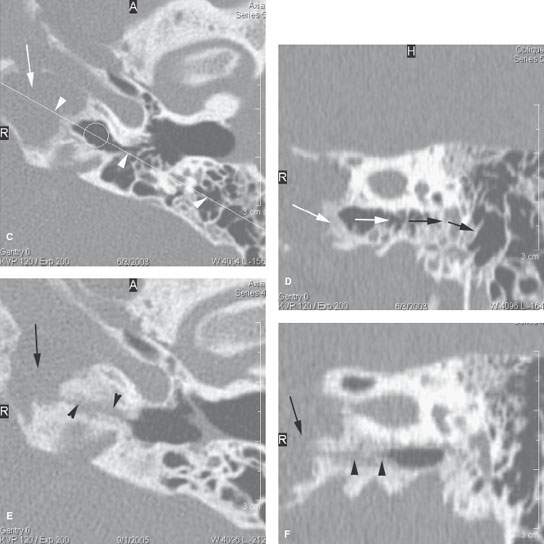 Petrous Apex Cholesterol Granuloma/Cholesterolosis, Mucocele, and ...