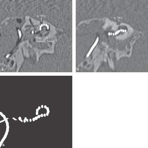 Otosclerosis | Radiology Key