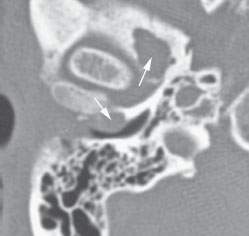 Benign Masses of the Middle Ear, and Mastoid | Radiology Key