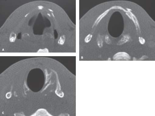 Vagal Neuropathy, Vocal Cord Weakness, and Referred Otalgia | Radiology Key
