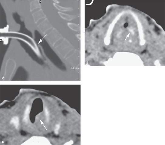Larynx: Iatrogenic Trauma and Subglottic Stenosis | Radiology Key