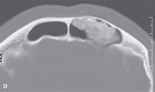 Fibrous Dysplasia and other Fibroosseous Lesions of Bone | Radiology Key