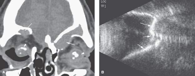 Eye: Trauma | Radiology Key