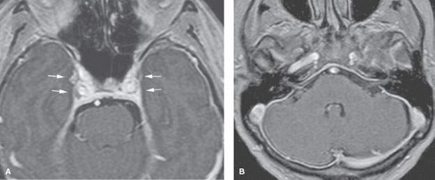 Disorders of Olfaction | Radiology Key