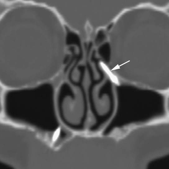 Acute and Subacute Mandibular and Dental Infections and Noninfectious ...