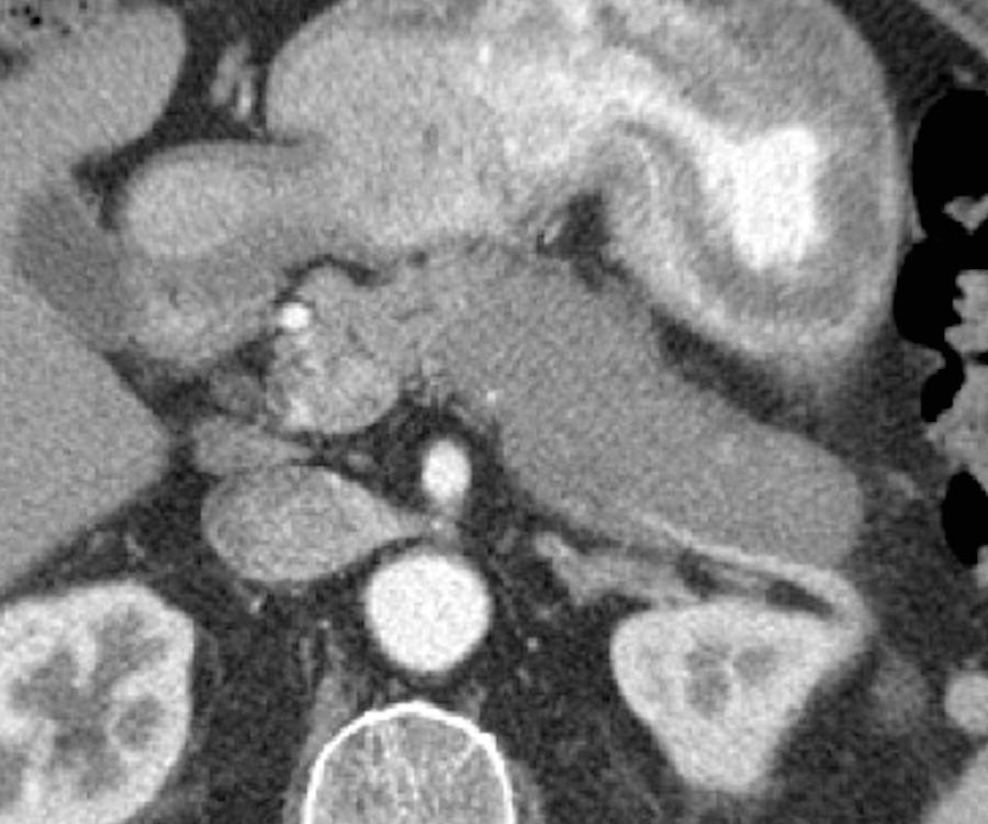 Pancreas | Radiology Key