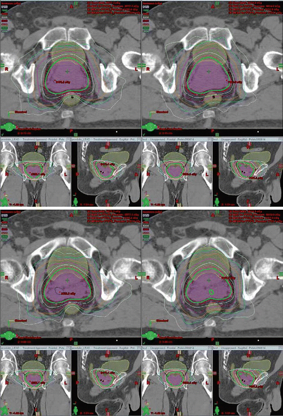 Early Prostate Cancer (T1–2N0M0) | Radiology Key