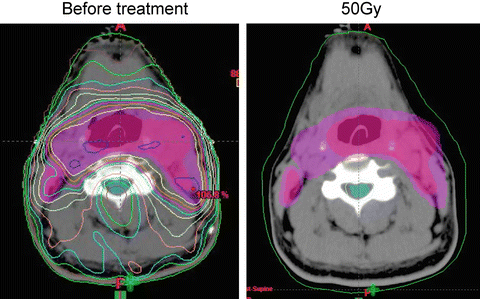 IGRT for IMRT | Radiology Key
