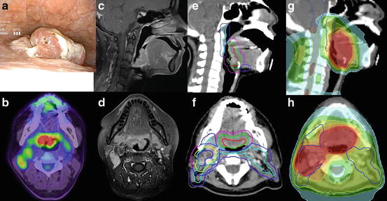 Oropharyngeal Cancer | Radiology Key