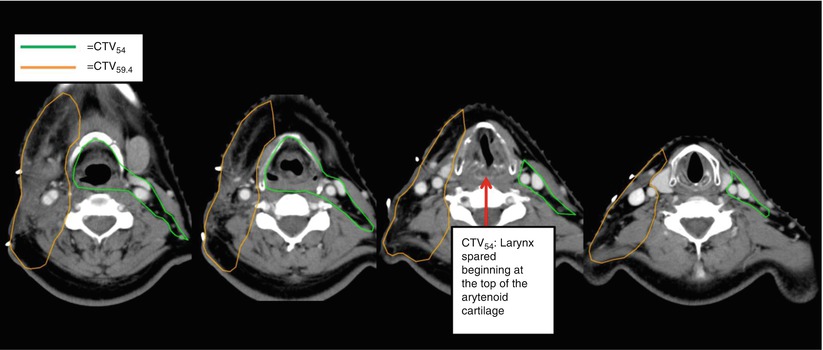 Cell Carcinoma of Unknown Primary in the Head and Neck | Radiology Key