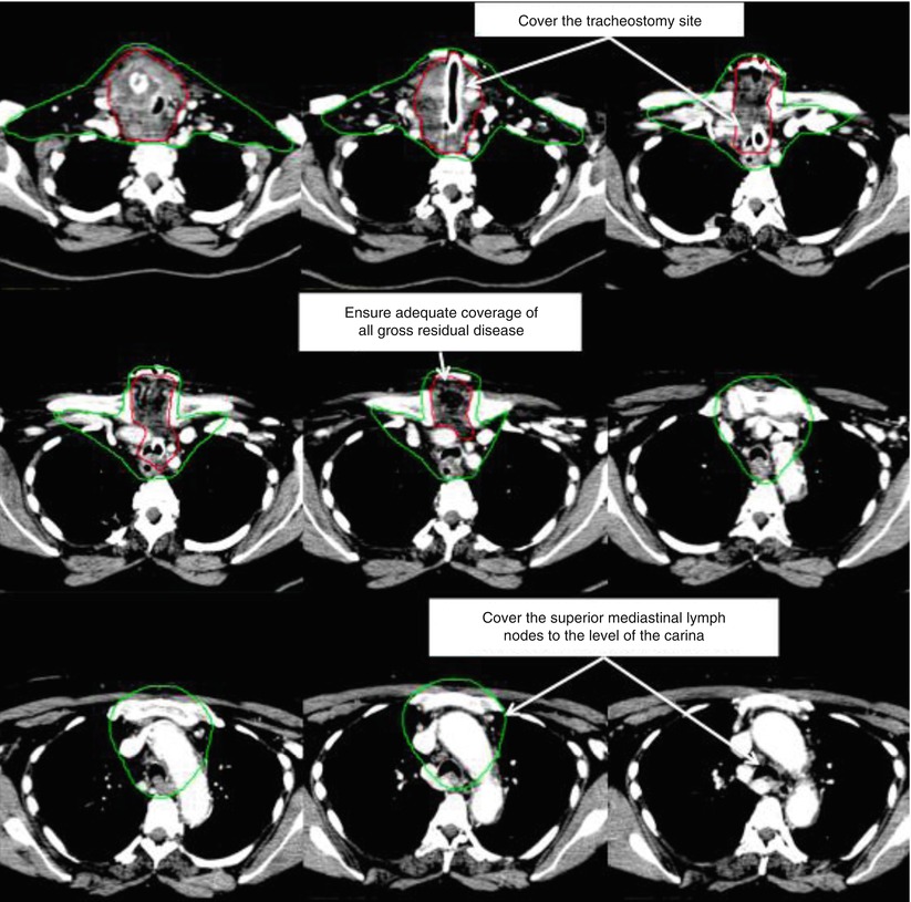 Carcinoma | Radiology Key